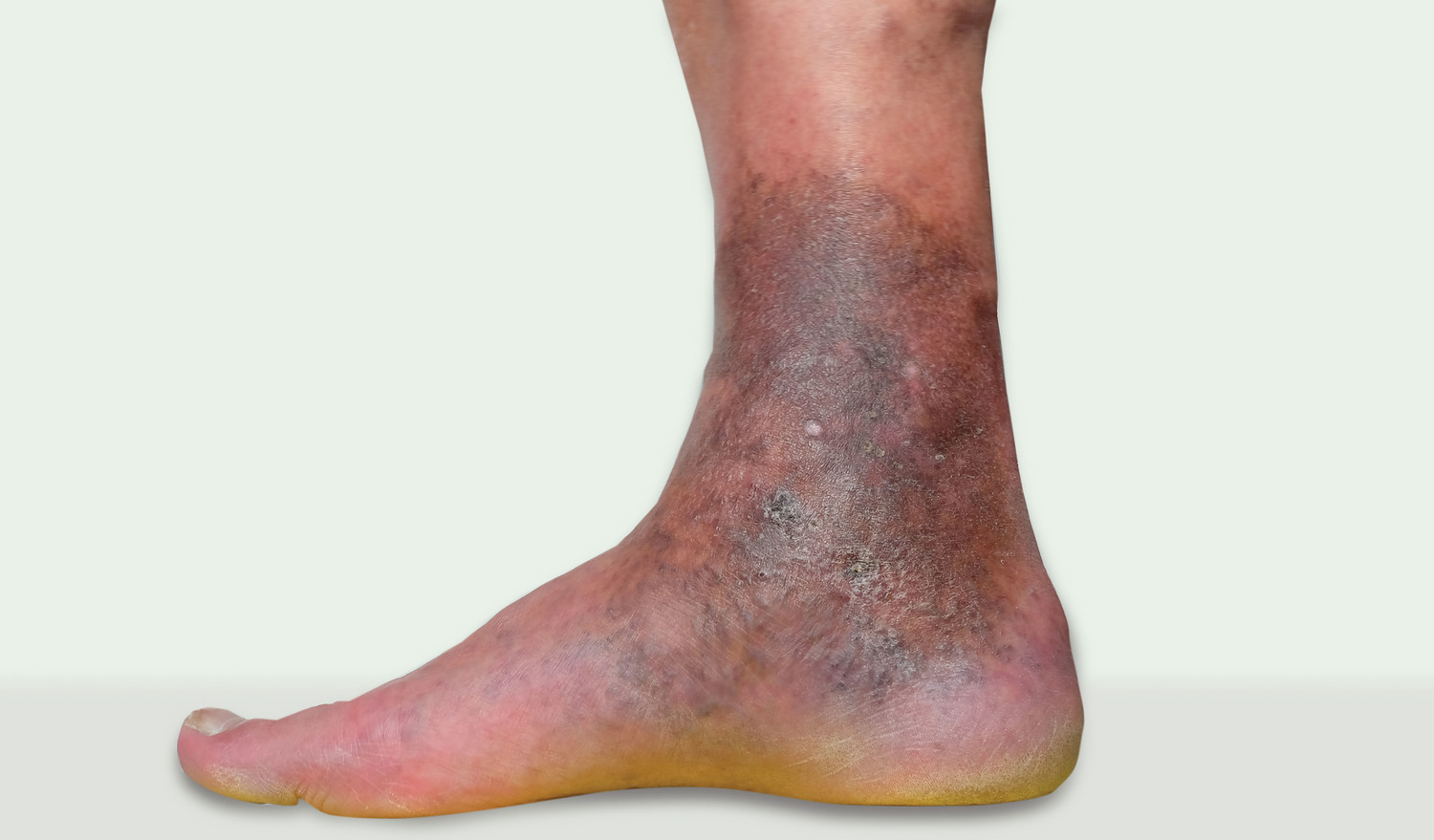 What Is Venous Stasis Disease Is There A Cure Sentara Martha What Is Venous Stasis Disease Is There A Cure Sentara Martha